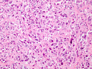 Sarcoma Diagnosis And Classification | Genomic Testing Cooperative