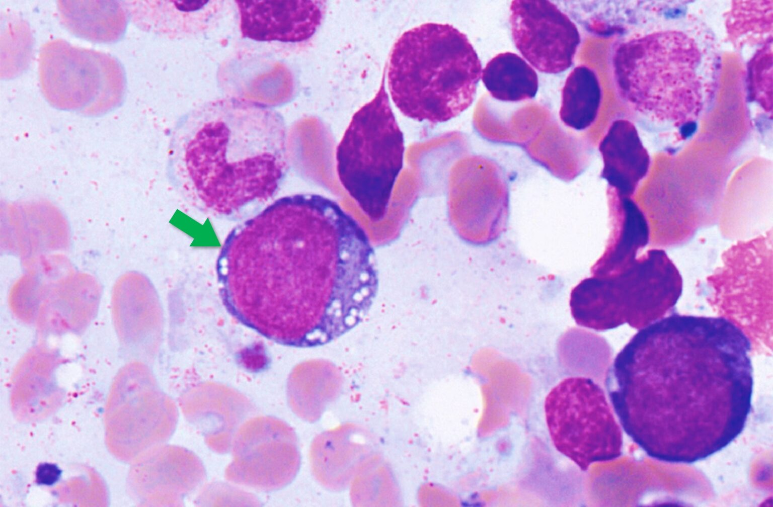 What Is VEXAS Disease? | Genomic Testing Cooperative